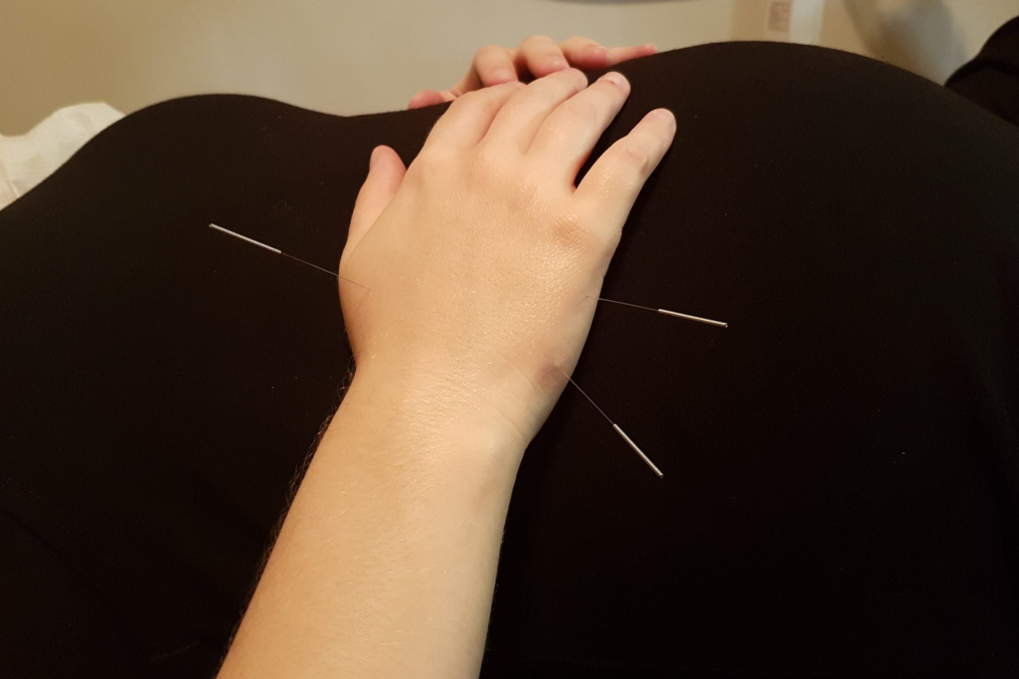 Ling gu【灵骨】22.05 and Da bai 【大白】22.04 Tung's Acupuncture Points ...