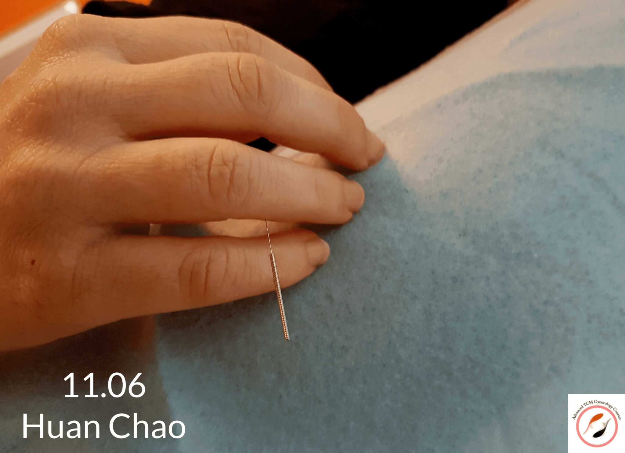 Master Tung's Three Weights Acupuncture points 77.05+ 77.06+ 77.07 【三重穴 ...