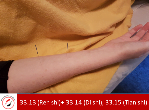 Tung's Acupuncture points 33.13 (Ren shi), 33.14 (Di shi), 33.15 (Tian ...
