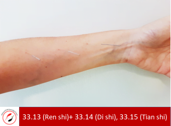 Tung's Acupuncture points 33.13 (Ren shi), 33.14 (Di shi), 33.15 (Tian ...