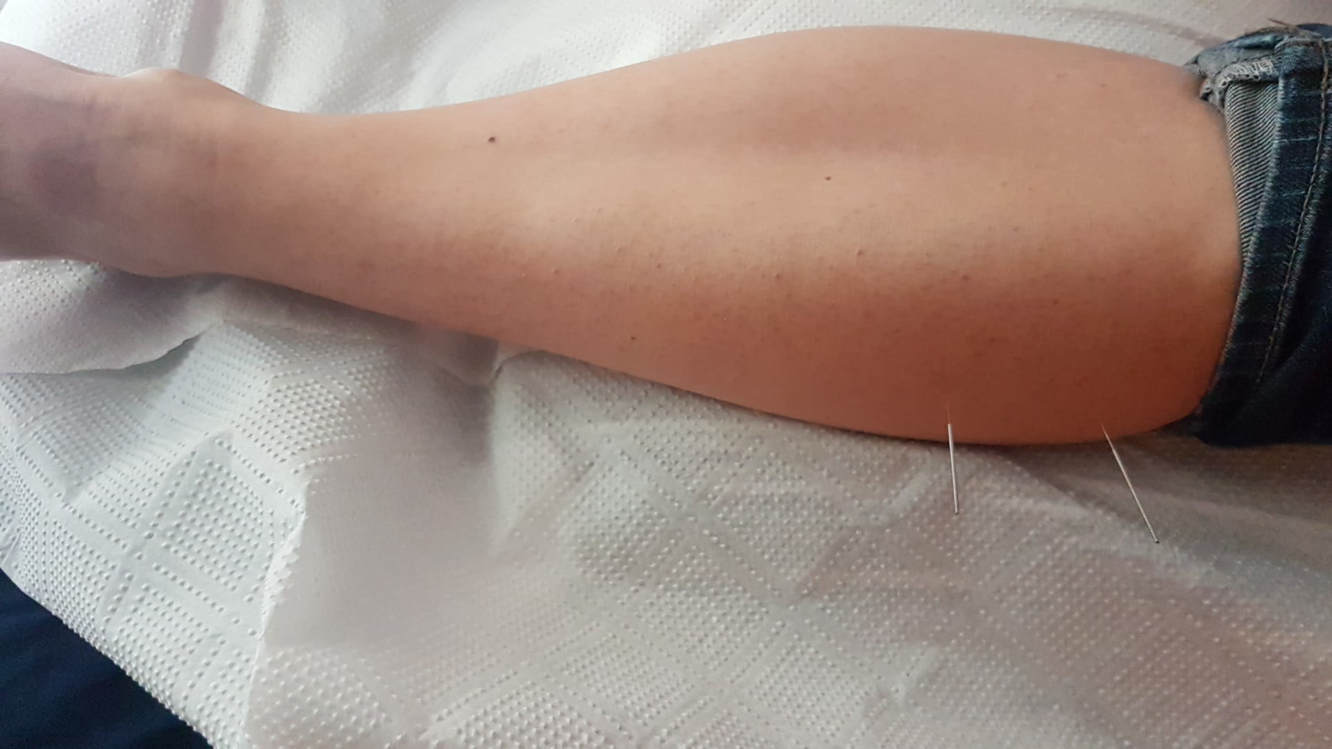 Master Tung's Three Weights Acupuncture points 77.05+ 77.06+ 77.07 【三重穴 ...