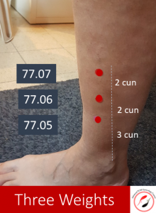 Master Tung's Three Weights Acupuncture points 77.05+ 77.06+ 77.07 【三重穴 ...